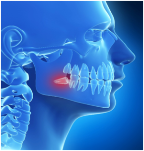 Wisdom Tooth Pain, What You Need To Know About Wisdom Teeth